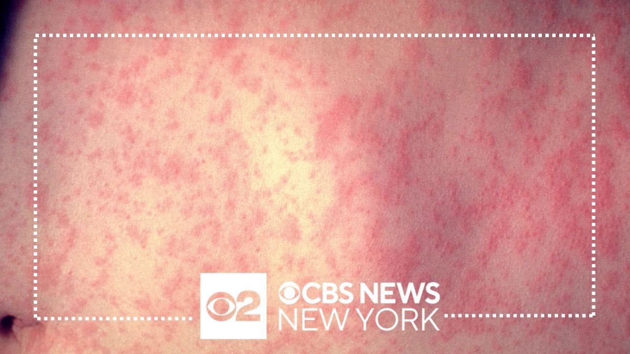 CDC Issues ‘Health Alert’ Over Measles Cases Across US - The Thinking ... CDC Issues ‘Health Alert’ Over Measles Cases Across US - The Thinking ...