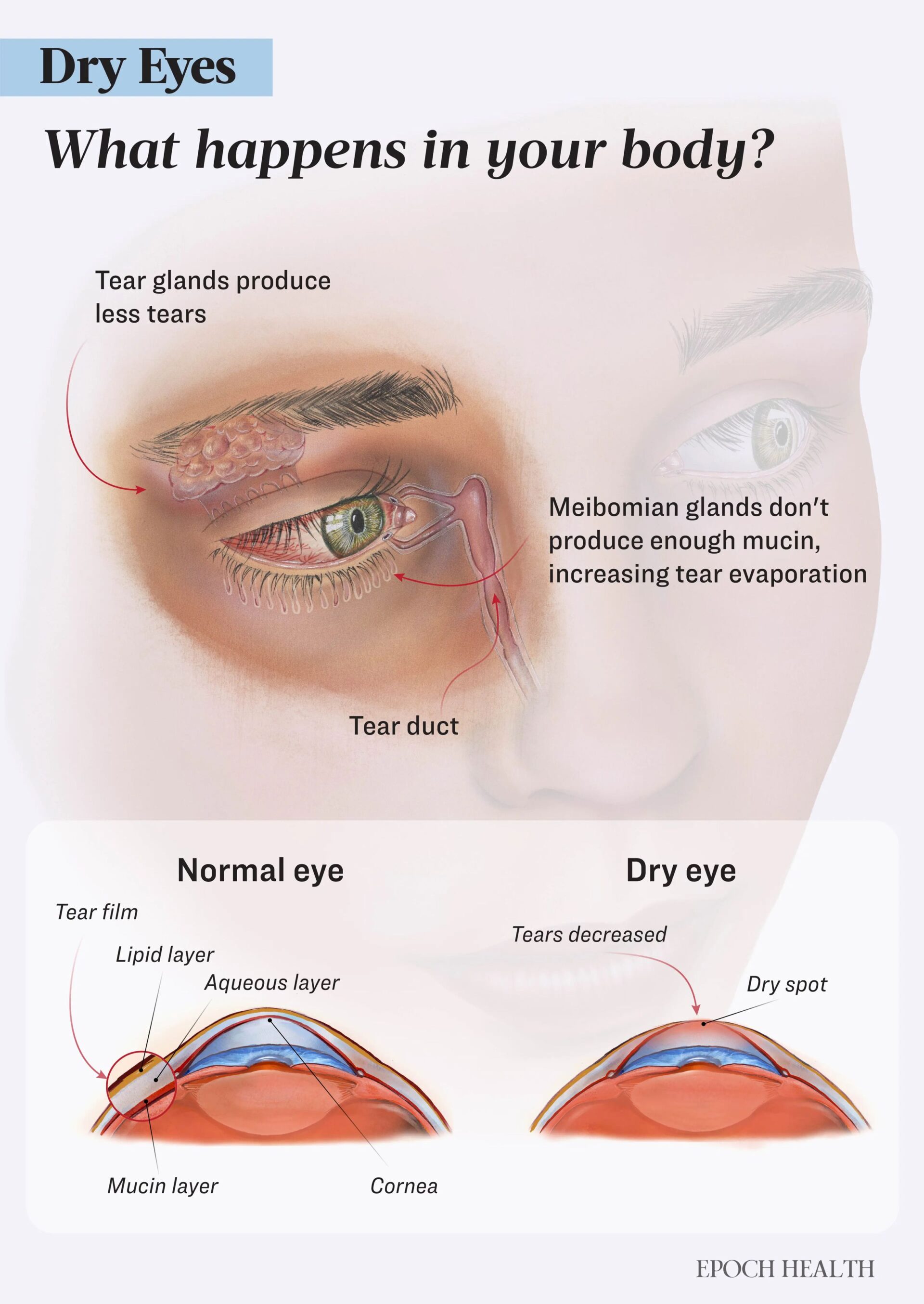 Dry Eye: Symptoms, Causes, Treatments, and Natural Approaches - The ...